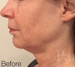 Forma Facial in LA: Your Secret to Firm, Radiant Skin